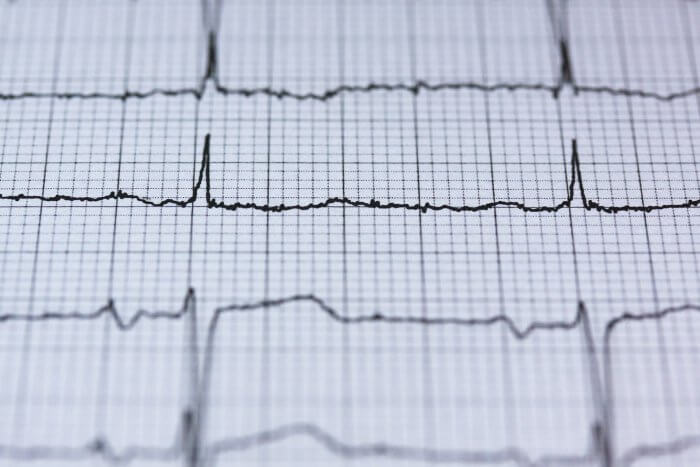 Rare cardiovascular diseases : Istituto Cardiocentro Ticino